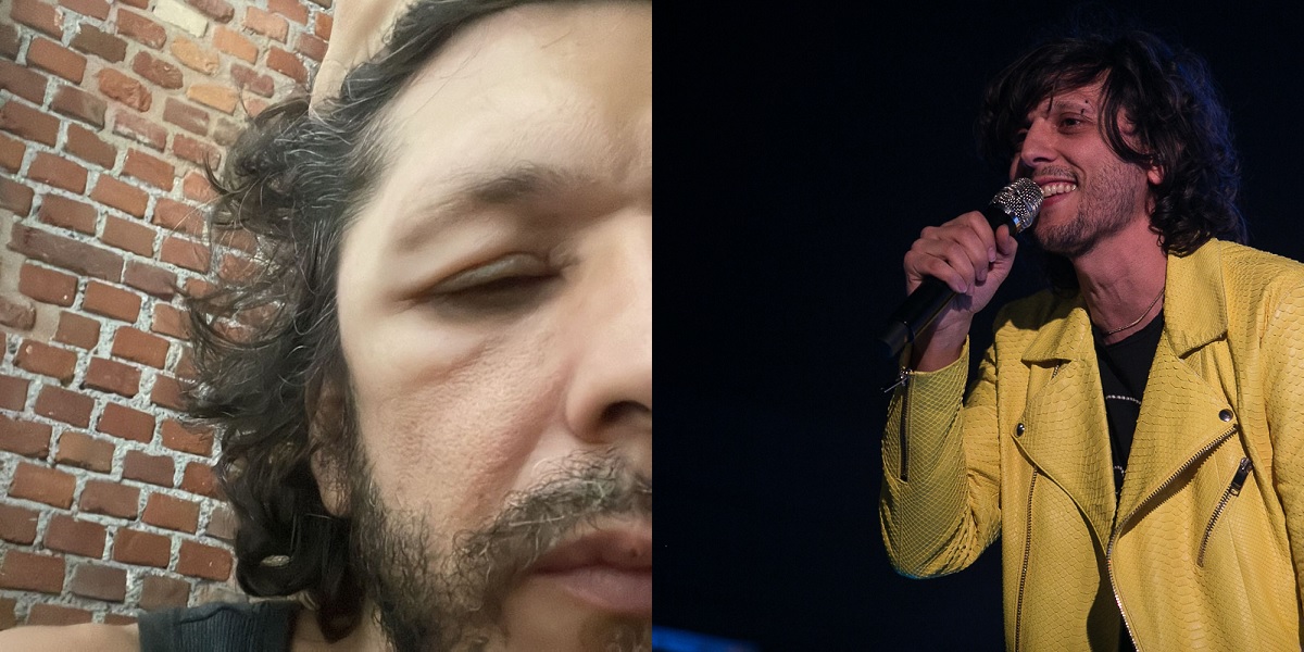 Le stories di Ermal Meta con il viso gonfio | Roba da Donne