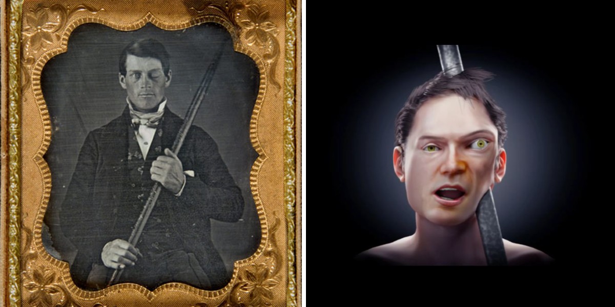La storia di Phineas Gage, sopravvissuto a un palo nel cervello | RDD