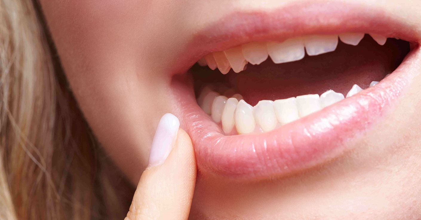 Gengive infiammate: cause e rimedi | Roba da Donne