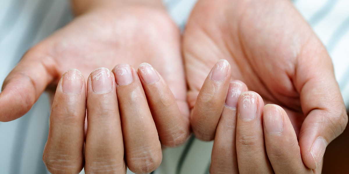 Capillaroscopia, cos'è e a che cosa serve | Roba da Donne