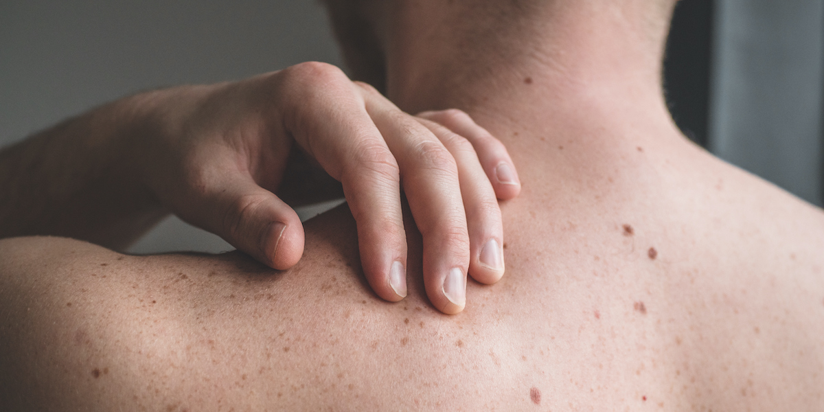 Prurito a un neo: le cause e quando preoccuparsi | Roba da Donne
