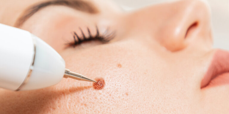 Prurito a un neo: le cause e quando preoccuparsi | Roba da Donne